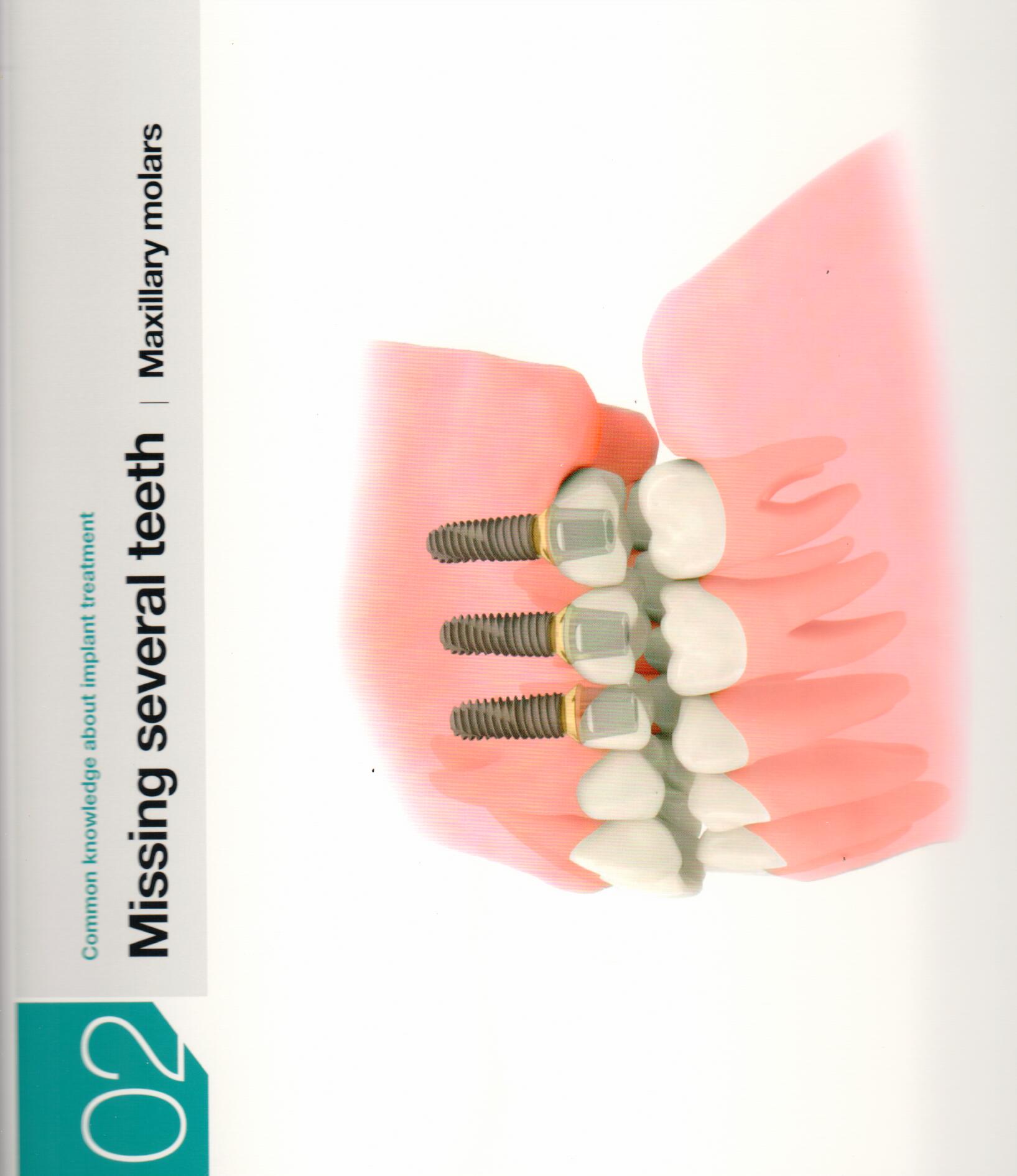 Implant, The Second Permanent Teeth (Osstem®) | Dental Clinics ...