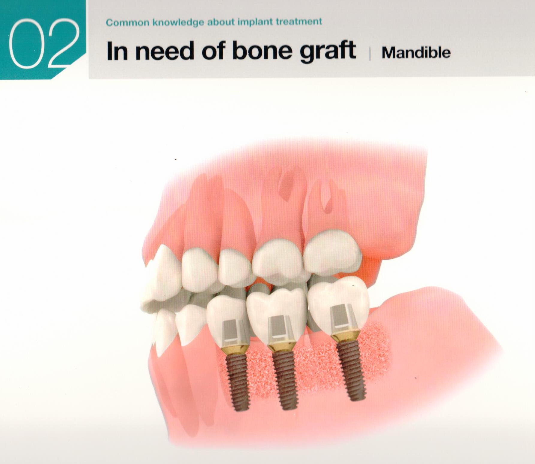 Implant, The Second Permanent Teeth (Osstem®) | Dental Clinics ...