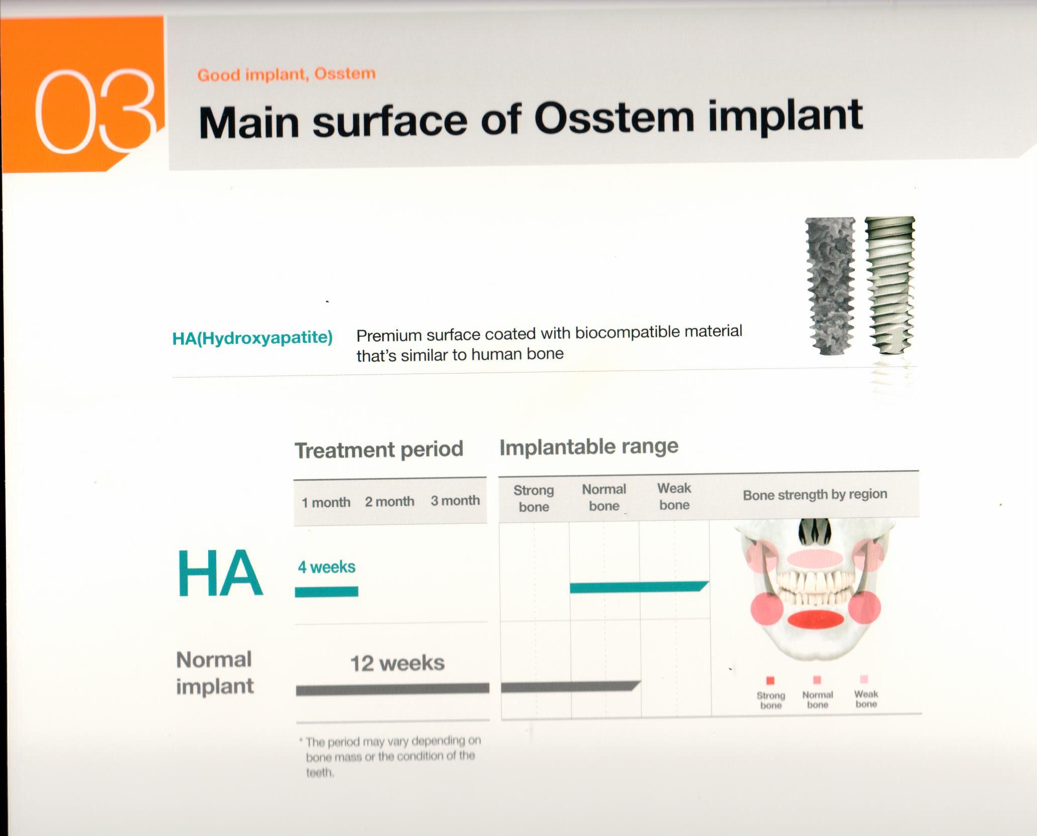 Implant, The Second Permanent Teeth (Osstem®) | Dental Clinics ...