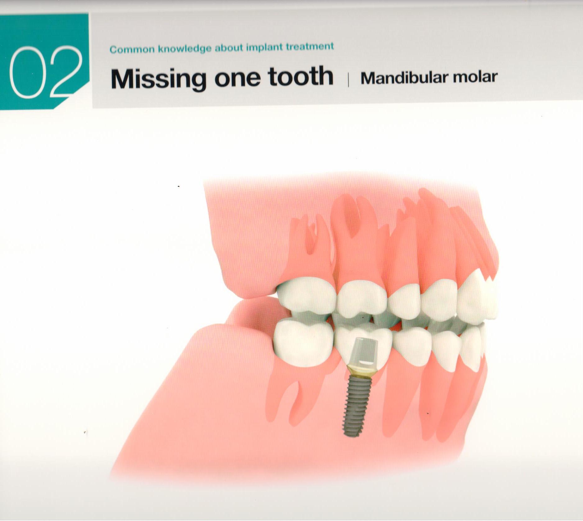 Implant, The Second Permanent Teeth (Osstem®) | Dental Clinics ...