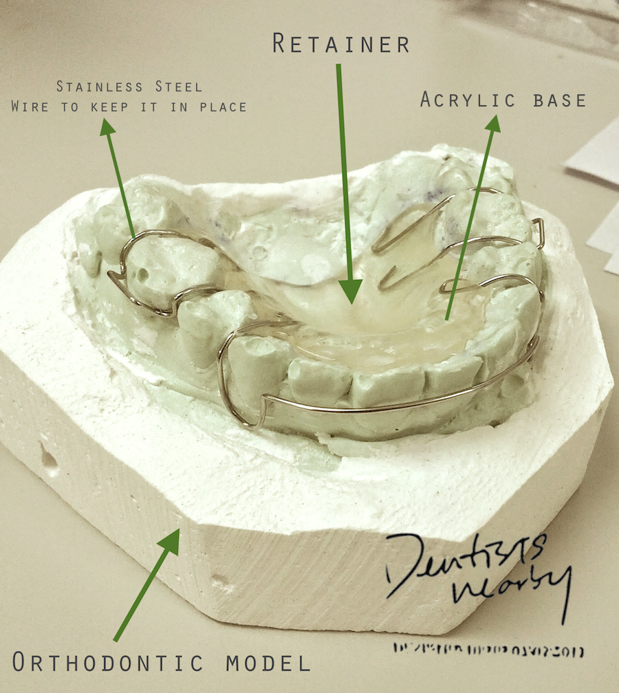 FAQs about Retainers. | Dental Clinics, Dentists, Klinik Gigi & 牙医 in ...