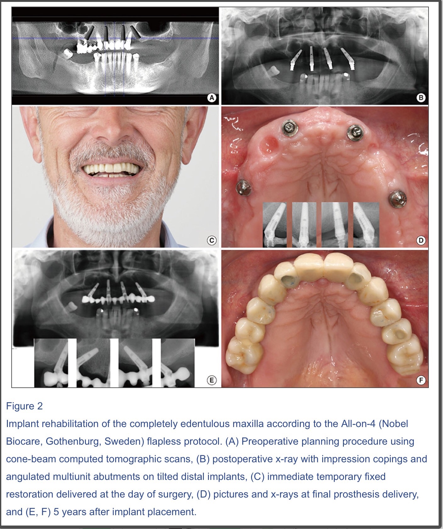 Realities of Immediately Loaded Dental Implants in the 21st century ...
