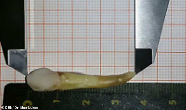 New World Record for Longest Tooth Set ! | Dental Clinics, Dentists ...