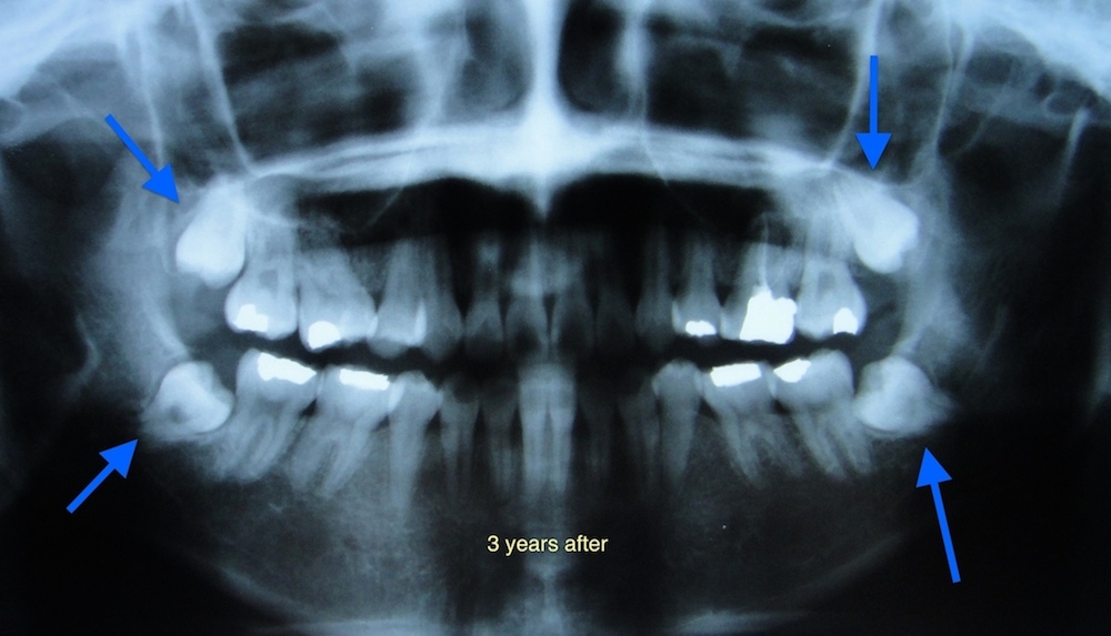Things to know about Wisdom Tooth Removal - Dr. Siddharth Dhanaraj ...
